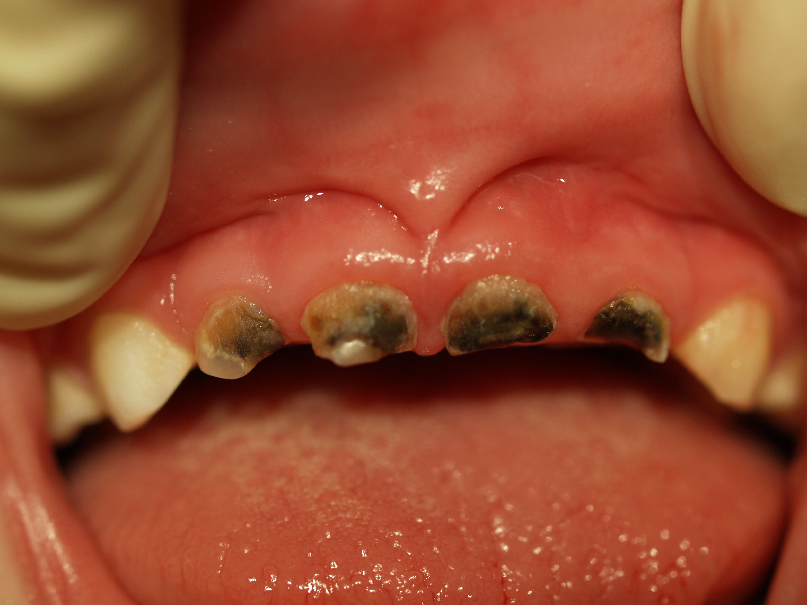 Rotten Teeth Children Preventing Tooth Decay – Rwanda Dental