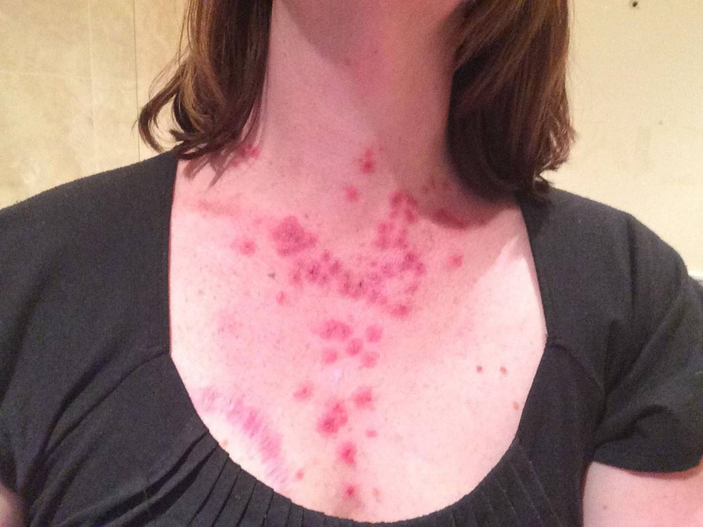 Mother Of Two Who Had An Annoying Spot On Her Chest In Her Wedding Photos Discovers It Was Skin